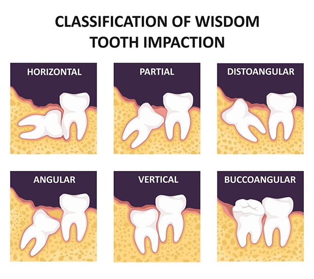 Wisdom Teeth Removal - St Lucie Center for Cosmetic Dentistry Port St ...